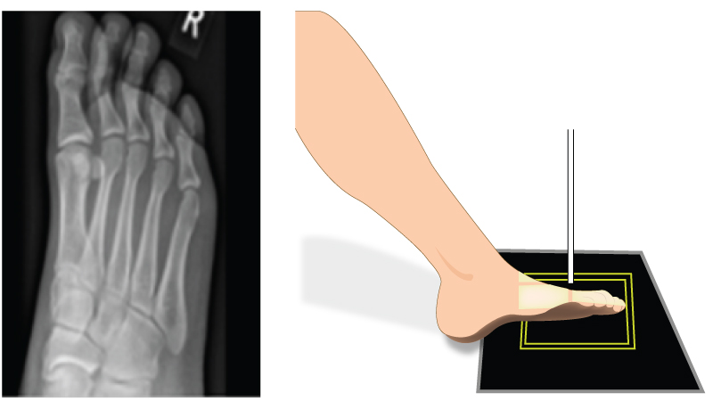 X-Ray Positioning Guide: Toes | Medical Professionals