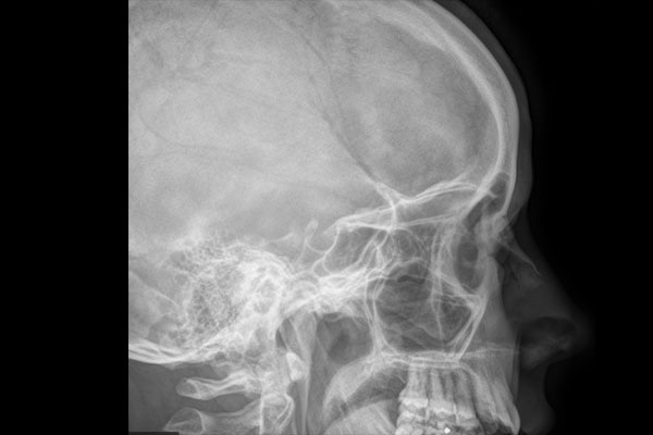 Sinus X-Ray Positioning: An X-Ray Guide - Medical Professionals