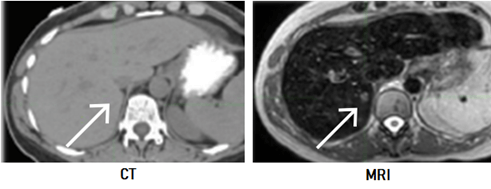 MR-Linac: Advances in Radiation Therapy