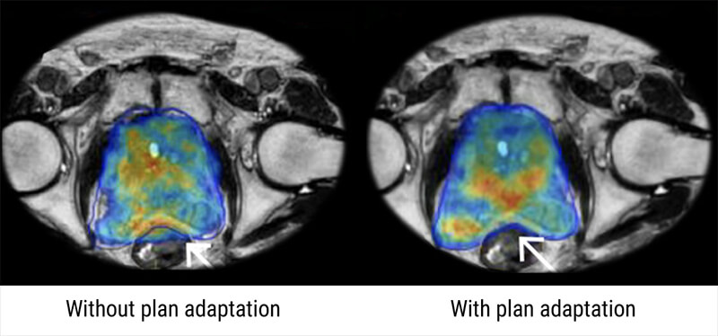 MR-Linac: Advances in Radiation Therapy